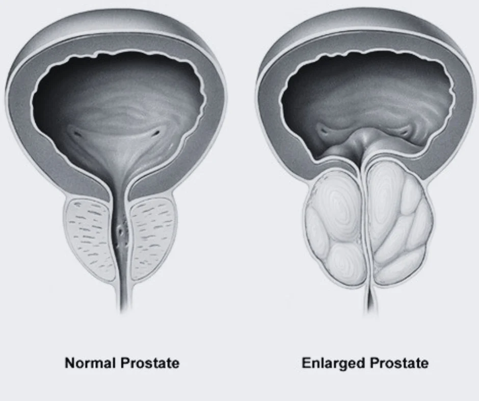 Understanding Prostate Cancer: 5 Unique Insights