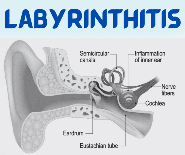 Understanding Labyrinthitis: 7 Shocking Facts & Cure