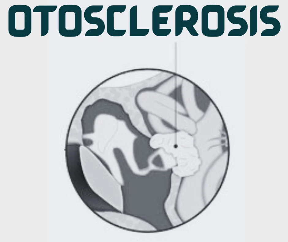 Understanding Otosclerosis: 7 Key Facts Exposed