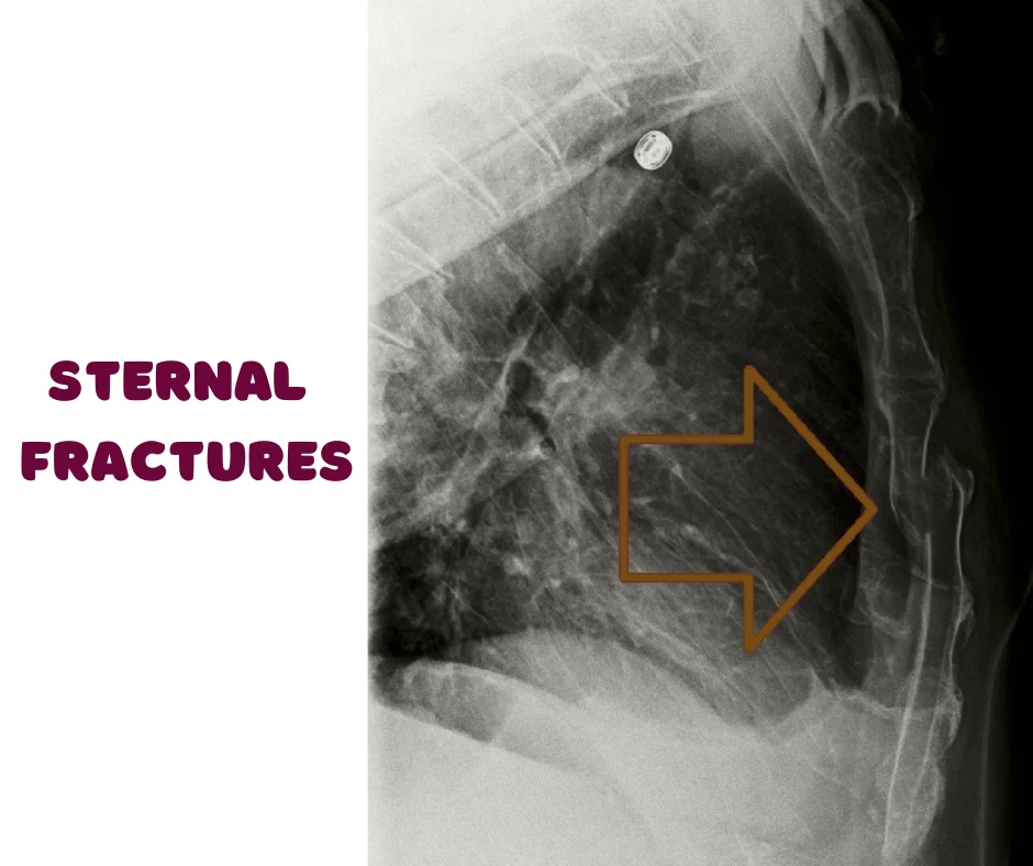Top 7 Signs Of A Sternal Fracture You Can't Ignore