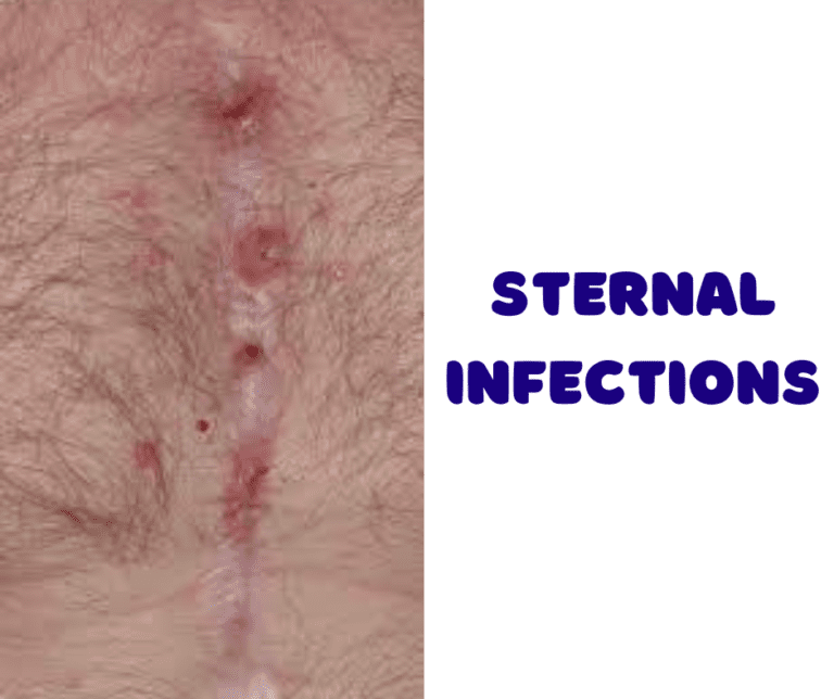 7 Warning Signs Of Sternal Infections (Must-Read)