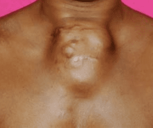 7 Alarming Signs Of Sternum Cancer You Must Know